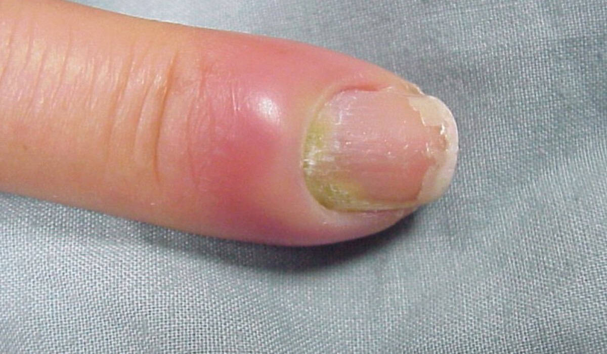 Ontstoken Nagelriem Behandelen: Effectieve Remedies en Tips