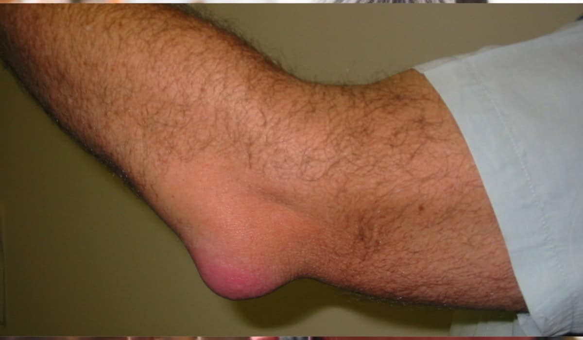 Slijmbeursontsteking: Oorzaken, Behandeling & Herstel