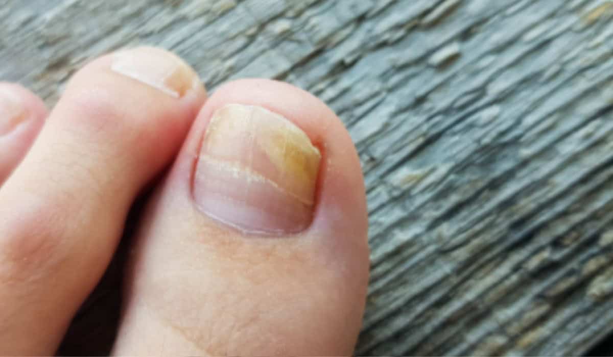 Ontstoken Nagelriem – Oma Weet Raad & Natuurlijke Tips
